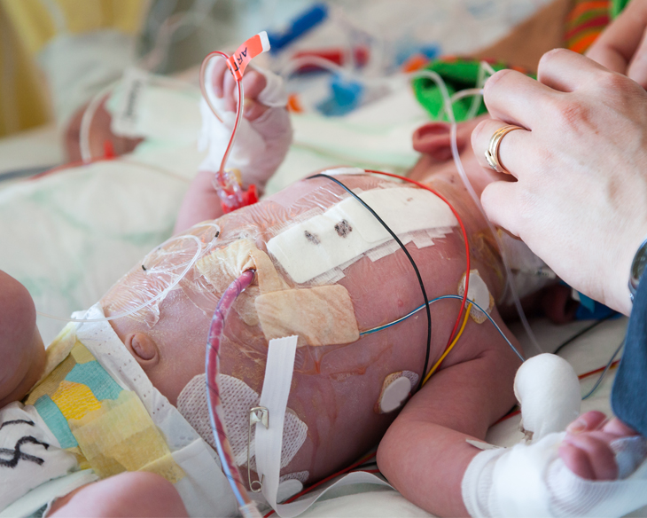 Largest Randomized Trial Evaluates Steroids for Infant Heart Surgery ...