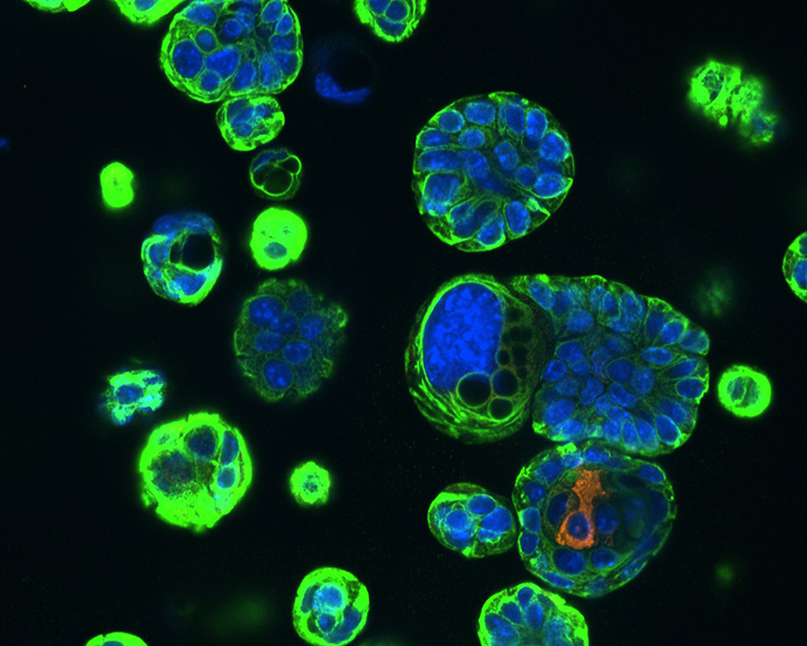 Basal Stem Cells Identified as Origin of Small Cell Lung Cancer in Lab ...